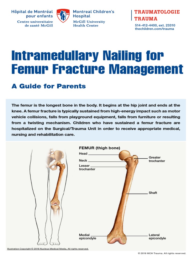 Intramedullary Nailing For Femur Fracture Web Version English | PDF ...