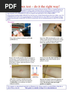 Positive Ppd Induration Size