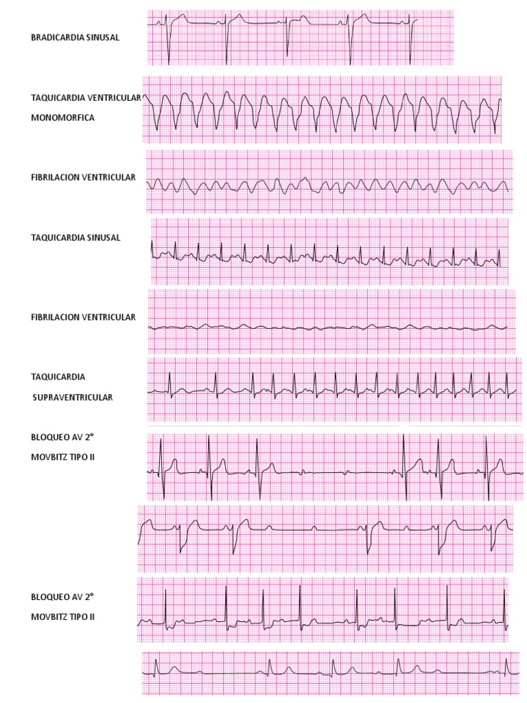 Ritmos Ekg | PDF