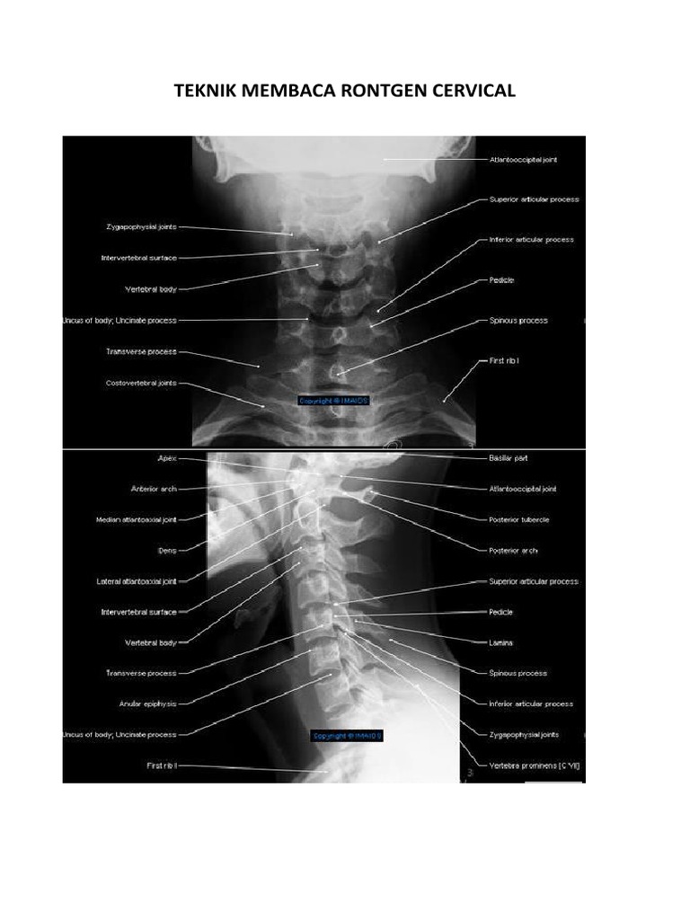 Teknik Membaca Rontgen Cervical | PDF
