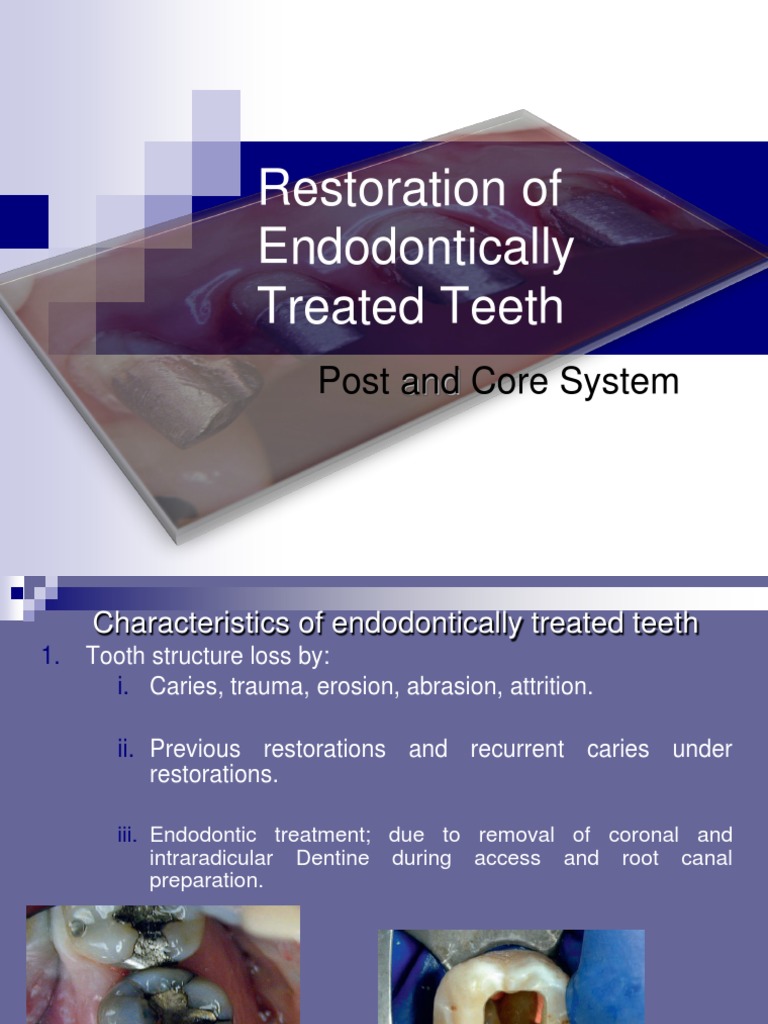 Restoration of Endodontically Treated Teeth: Post and Core System | PDF ...