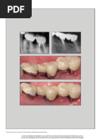 Zimmer Trabecular Metal Tibial Cone Surgical Technique | PDF | Dental ...