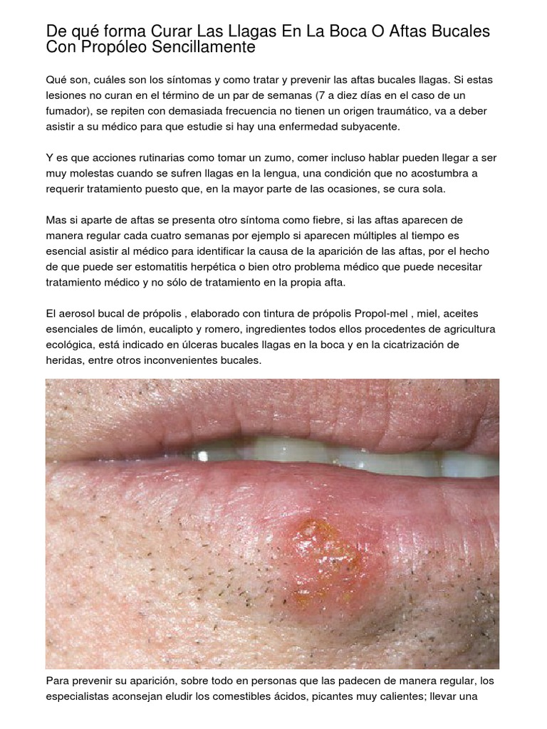 De Qué Forma Curar Las Llagas en La Boca O Aftas Bucales Con Propóleo ...