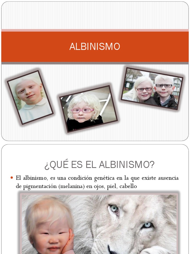 Albinismo // Presentacion Informativa | PDF | Ciencias sociales ...