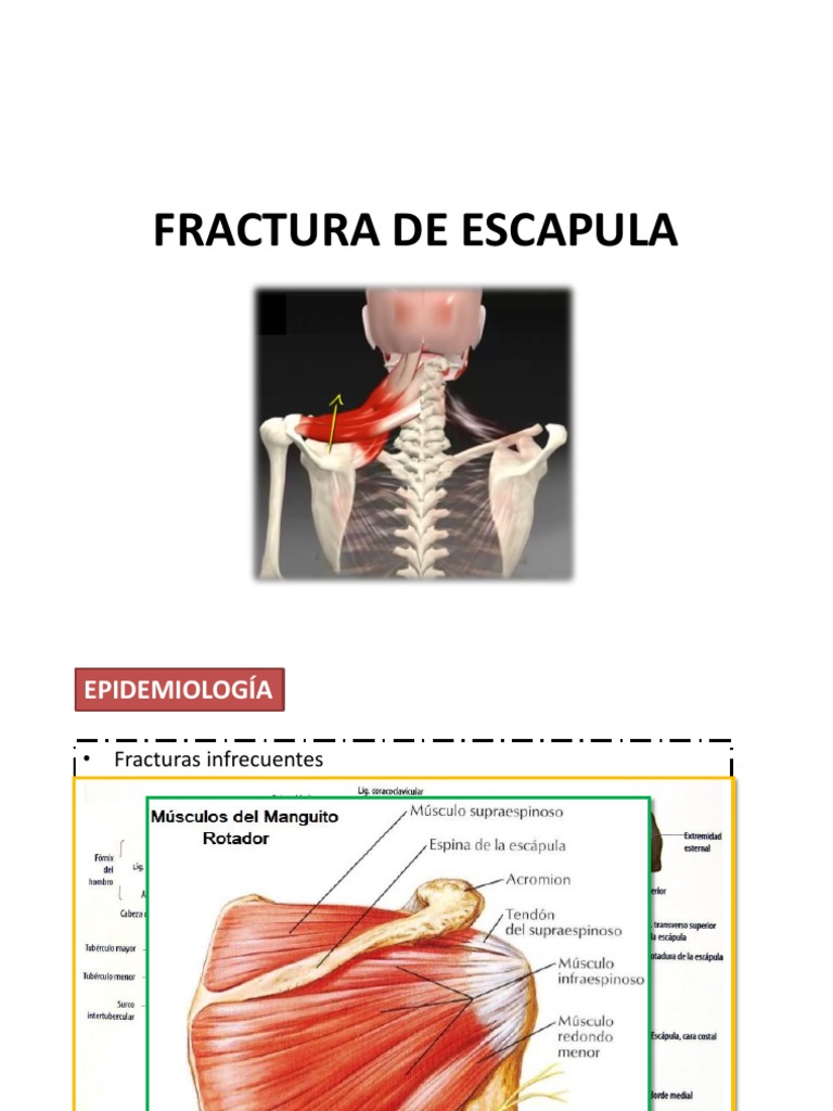 Expo Fractura de Escapula | PDF | Hombro | Extremidades (anatomía)
