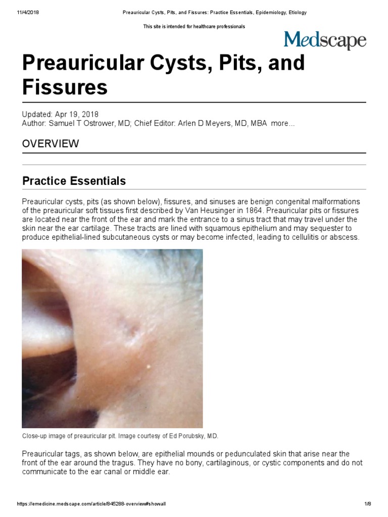 Ostrower Preauricular Cysts, Pits, and Fissures - Practice Essentials ...