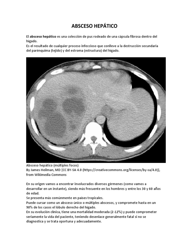 Absceso Hepático | PDF | Medicina | Enfermedades y trastornos
