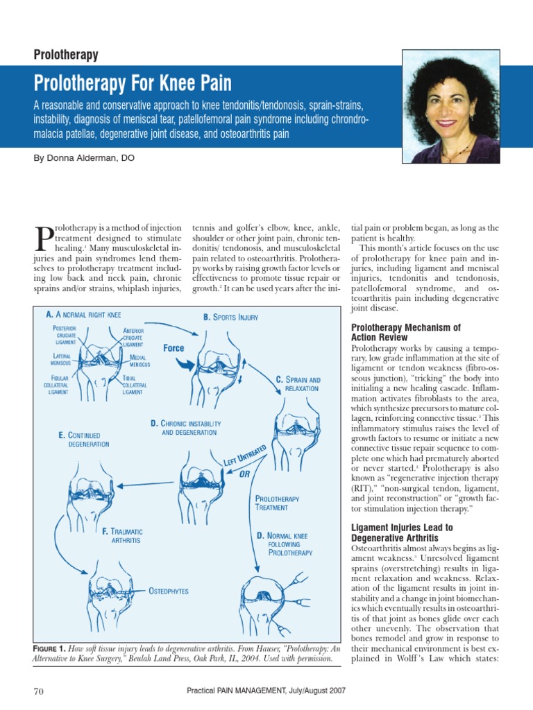 Prolotherapy For Knee Pain | PDF | Knee | Osteoarthritis