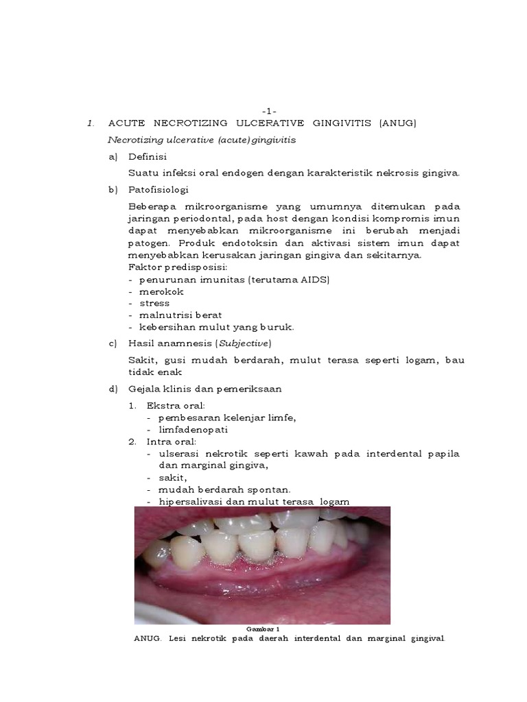 Acute Necrotizing Ulcerative Gingivitis | PDF