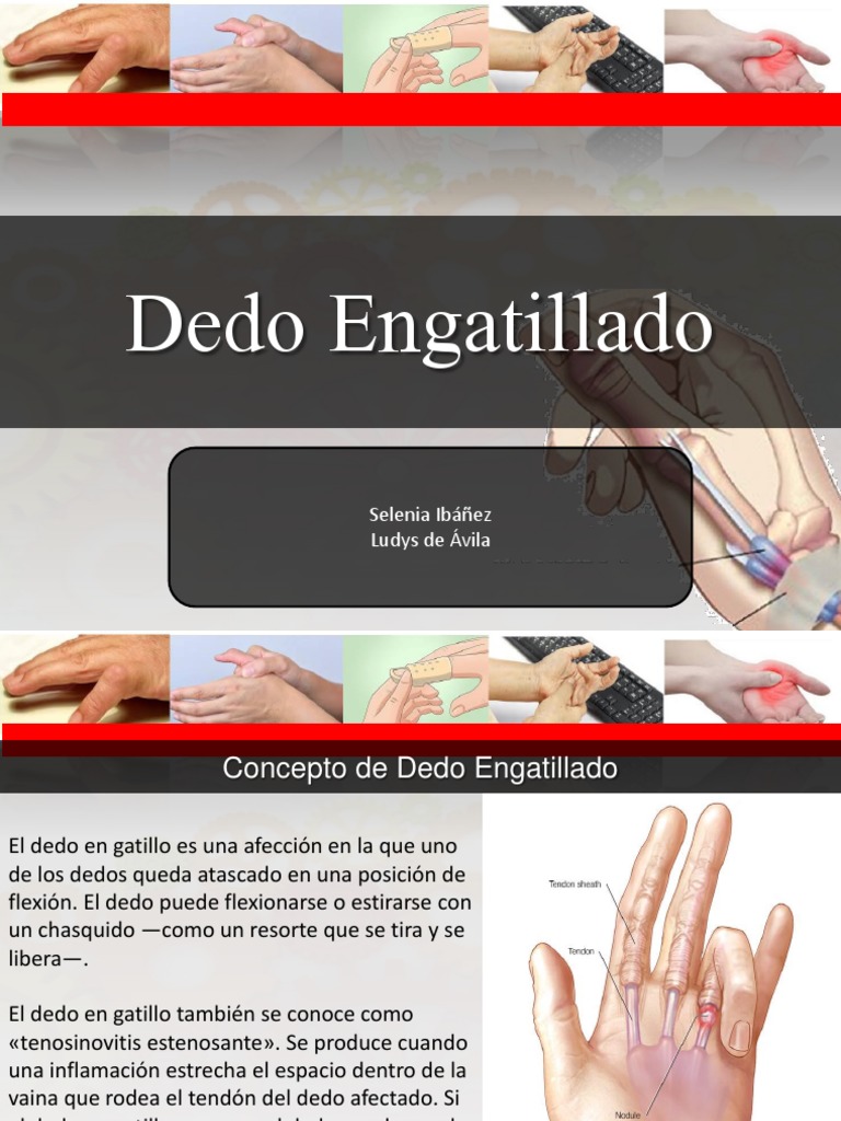 Dedo Engatillado: Causas y Tratamientos | PDF | Tendón | Cirugía
