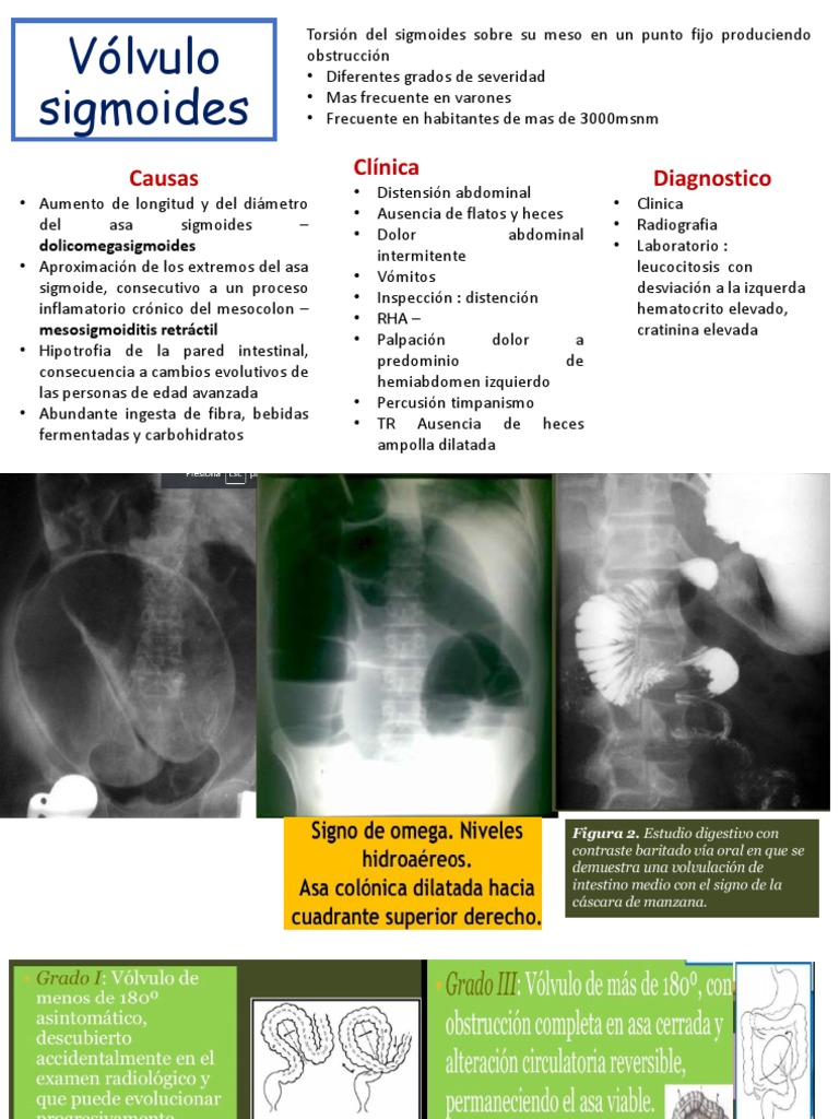 Vólvulo Sigmoides | PDF