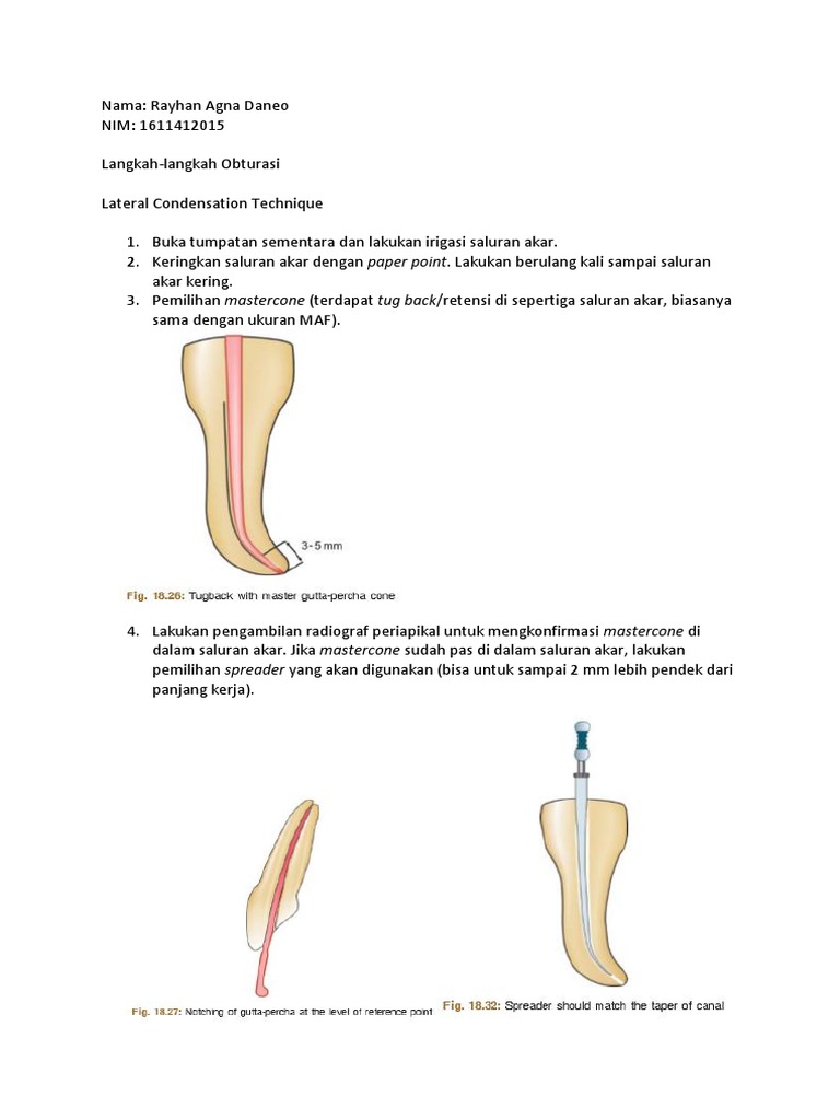 Langkah-Langkah Obturasi | PDF