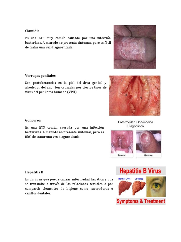 Clamidia | PDF