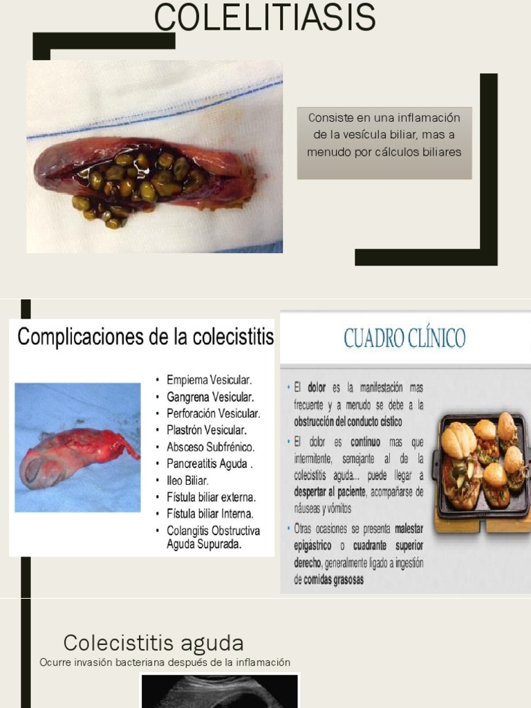 Colelitiasis | PDF | Inmunología | Enfermedades y trastornos