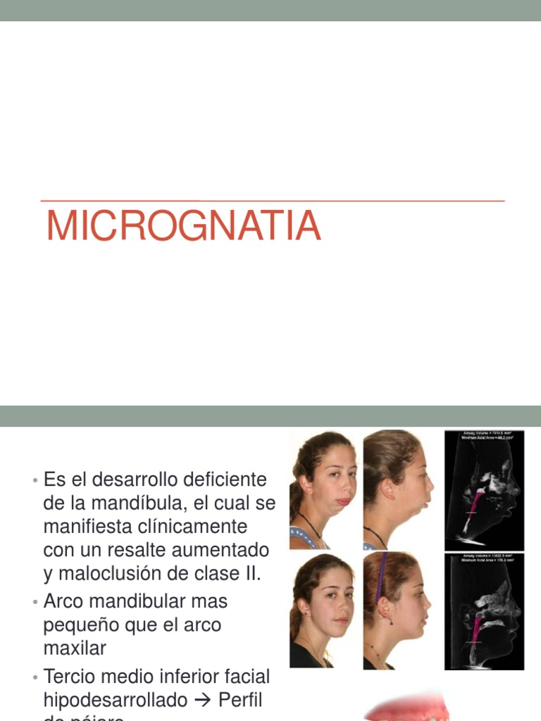 Micrognatia | PDF