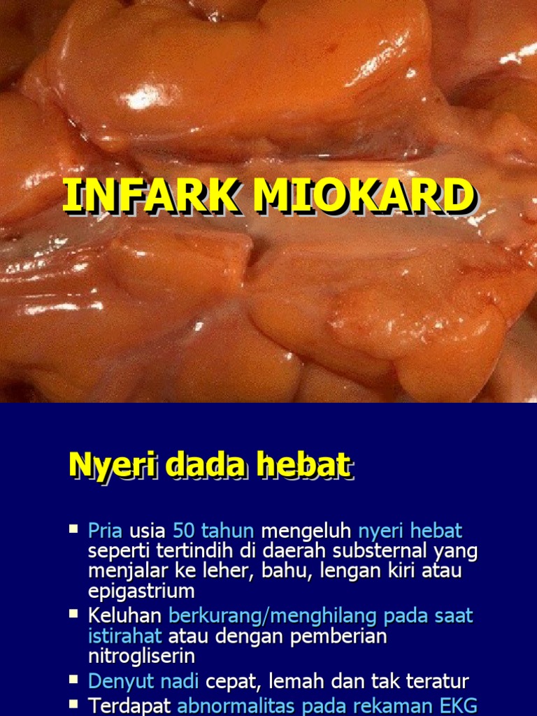 Infark Miokard | PDF