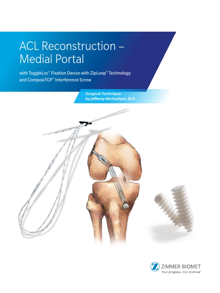 Acl Reconstruction Medial Portal With Toggleloc Fixation Device With ...