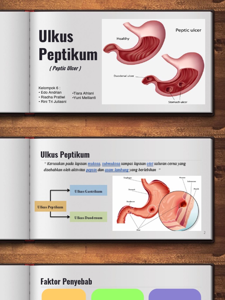 Ulkus Peptikum 2A | PDF