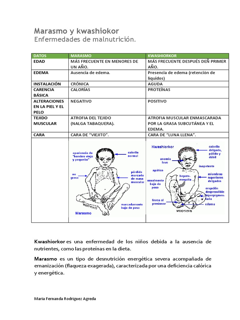 Marasmo y Kwashiokor | PDF | Dieta | Desnutrición