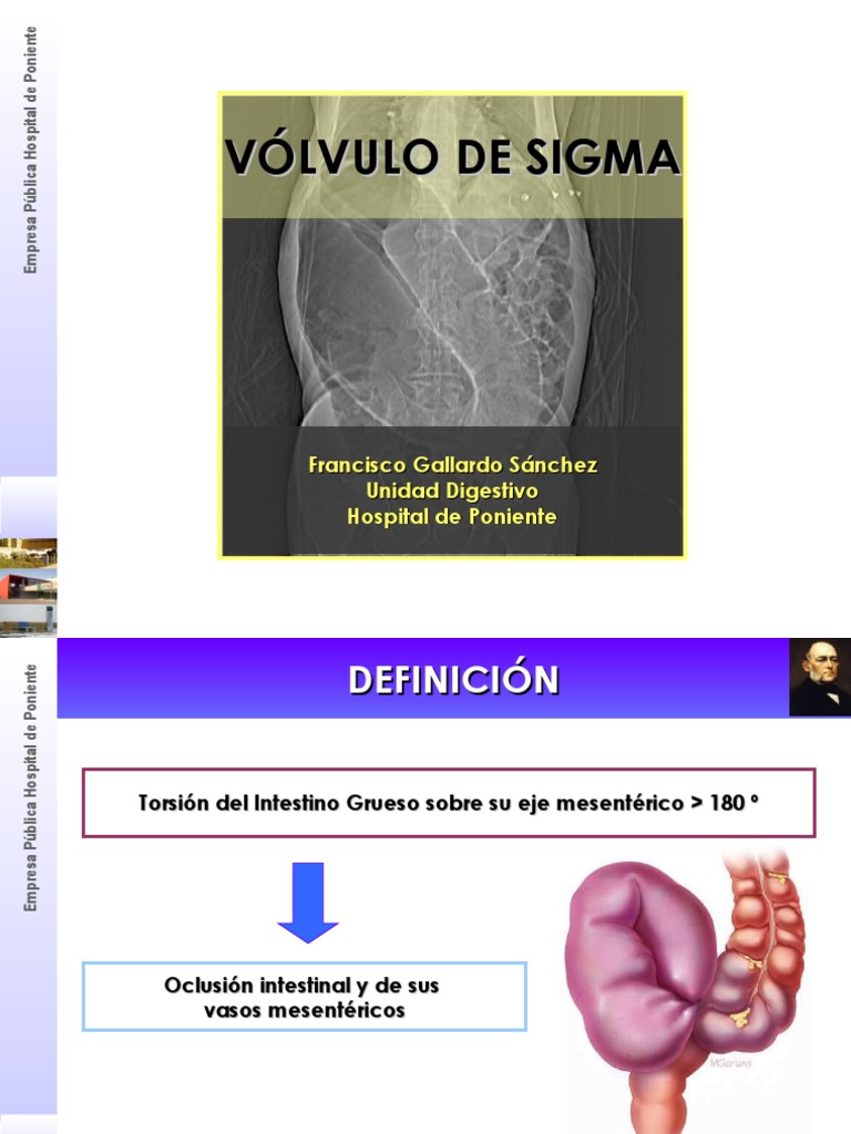 Volvulo de Sigma | Abdomen | Estreñimiento