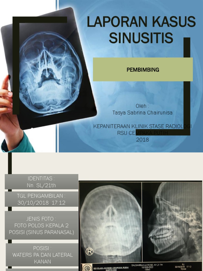 Lapkas - Sinusitis | PDF