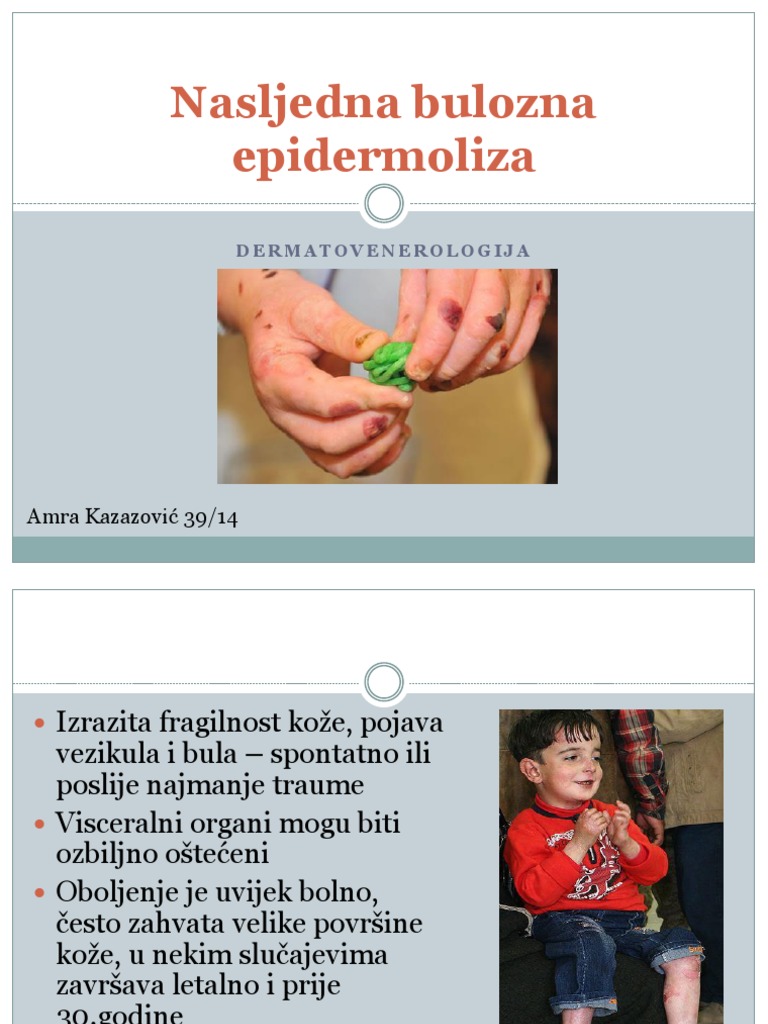 Nasljedna Bulozna Epidermoliza | PDF