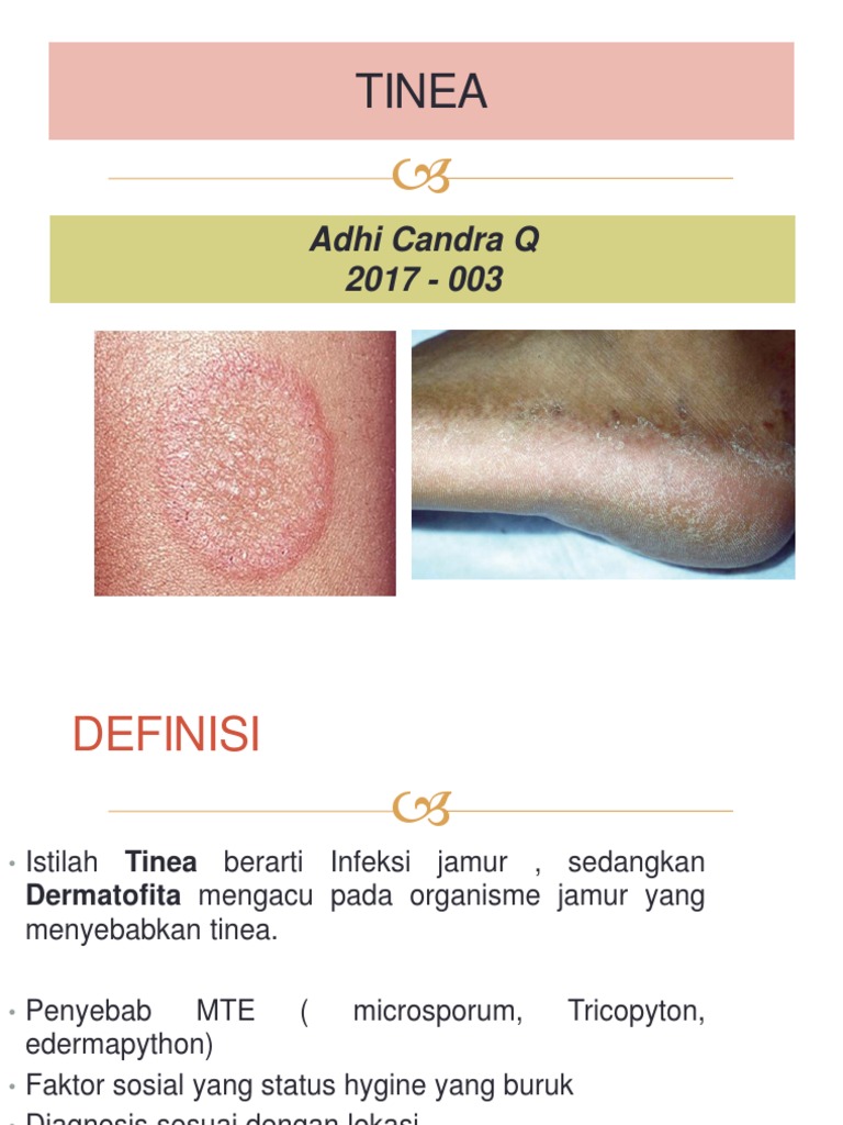 Panduan Tinea: Jenis dan Pengobatan | PDF