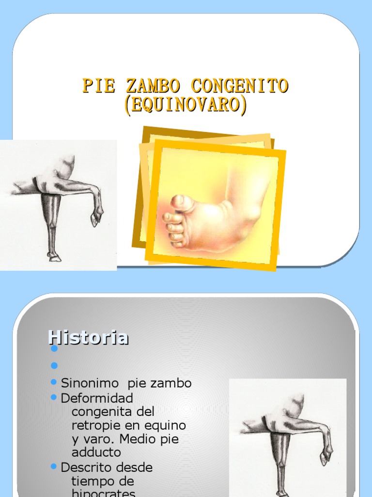 Pie Zambo Congenito Equinovaro | PDF | Pie | Tobillo