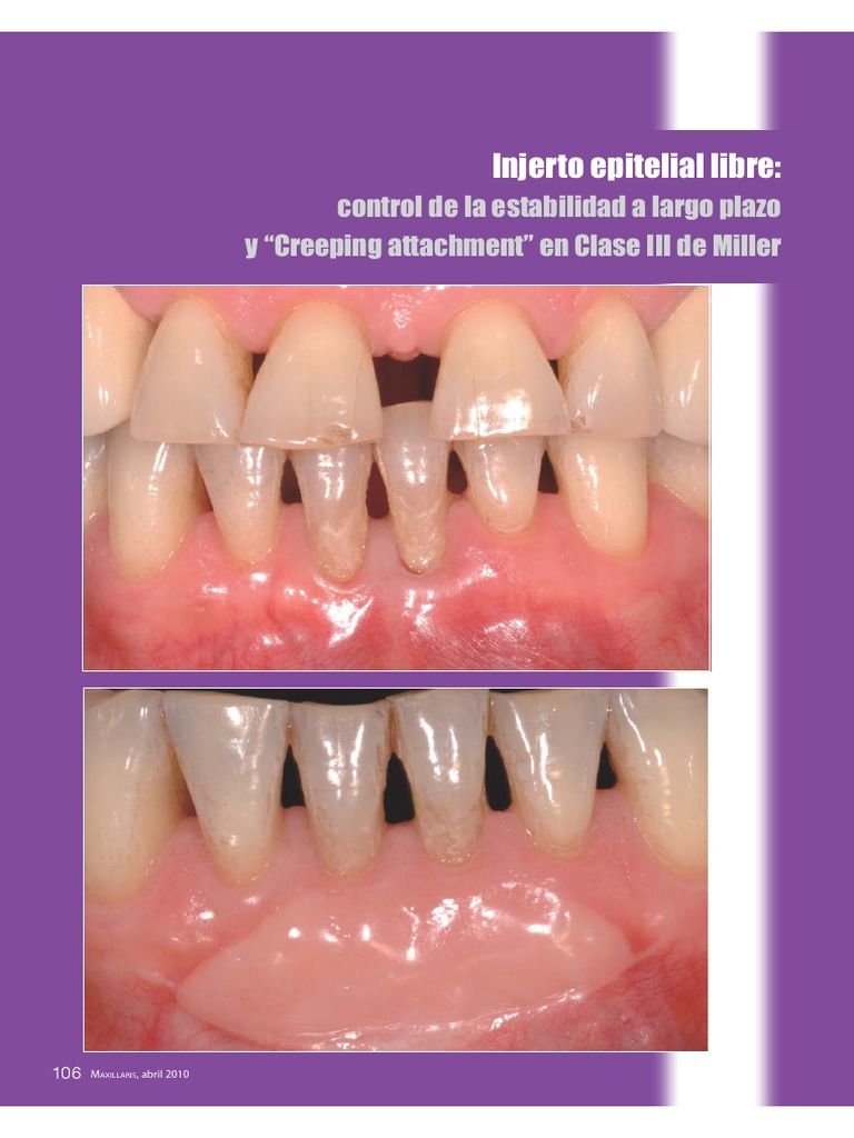 Injerto epitelial libre:: control de la estabilidad a largo plazo y ...