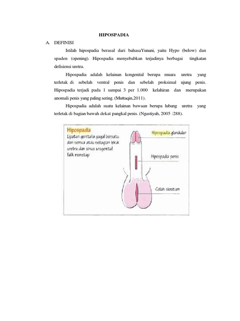 Hipospadia PDF | PDF