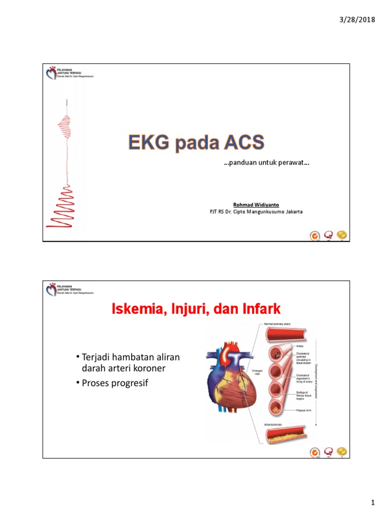 EKG Pada ACS Workshop | PDF