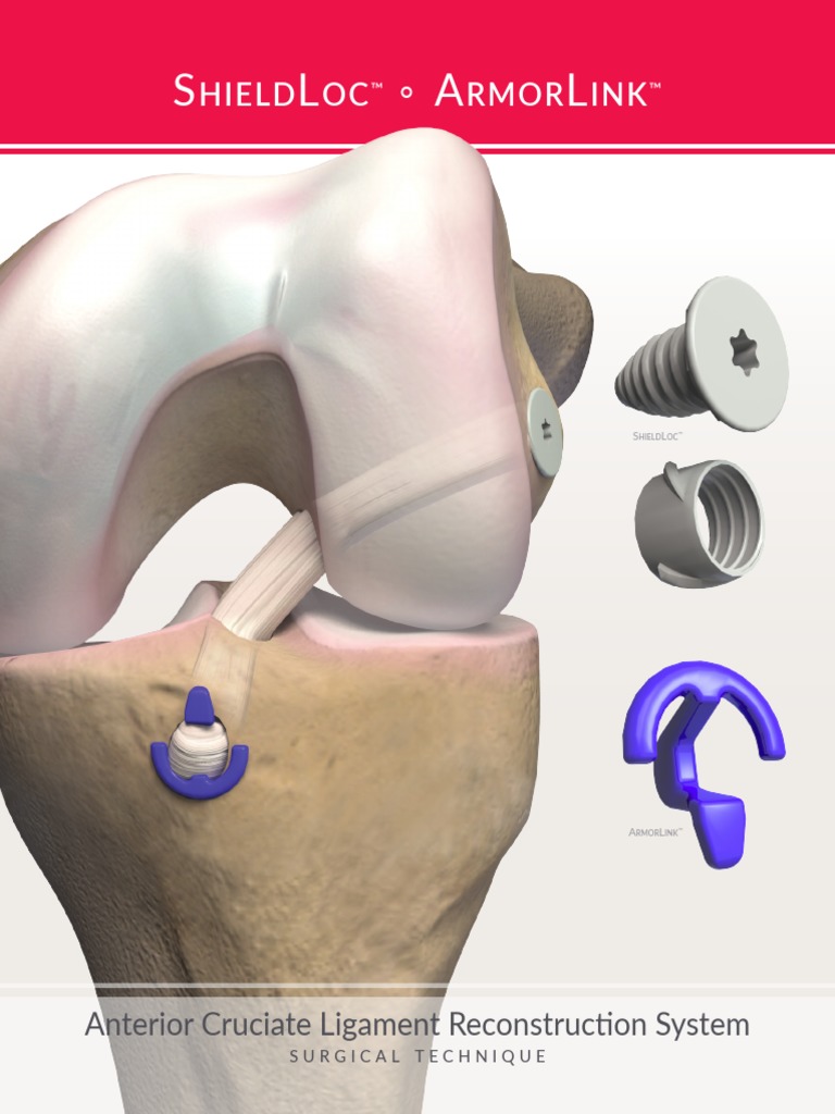 ACL Surgical Technique - Final DRAFT.3.15.16 | PDF | Lower Limb Anatomy ...