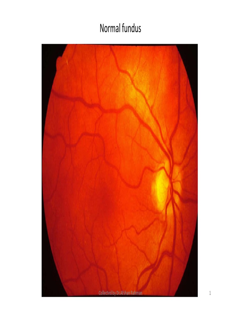 Normal Fundus Findings by Dr. Rahman | PDF | Home & Garden | Wellness
