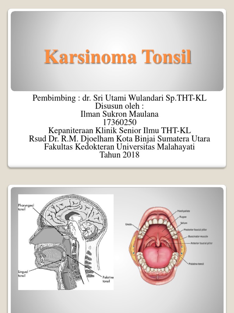Slide Refarat CA Tonsil | PDF