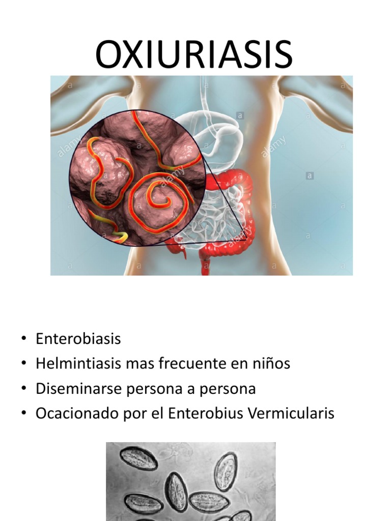 OXIURIASIS | Especialidades Medicas | Medicina CLINICA