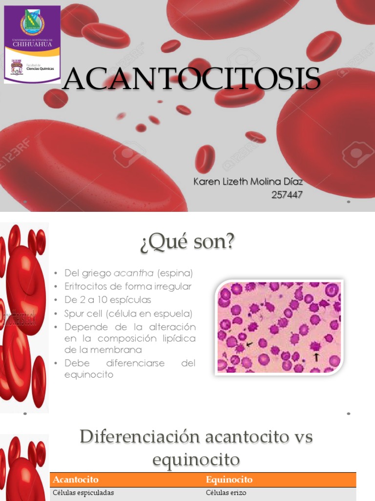 ACANTOCITOSIS | Membrana celular | Glóbulo rojo