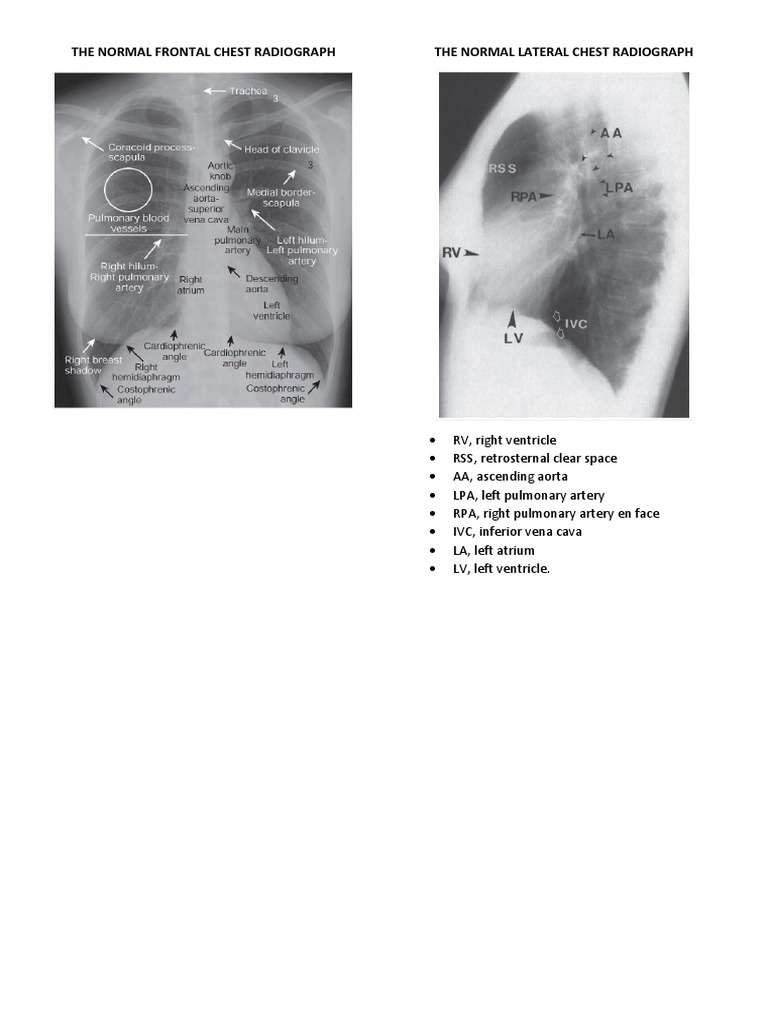 The Normal Frontal Chest Radiograph The Normal Lateral Chest Radiograph ...