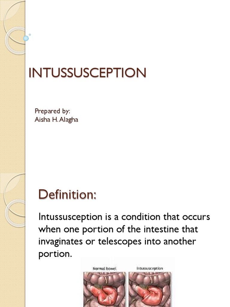 Intussusception: Prepared By: Aisha H. Alagha | PDF | Digestive System ...