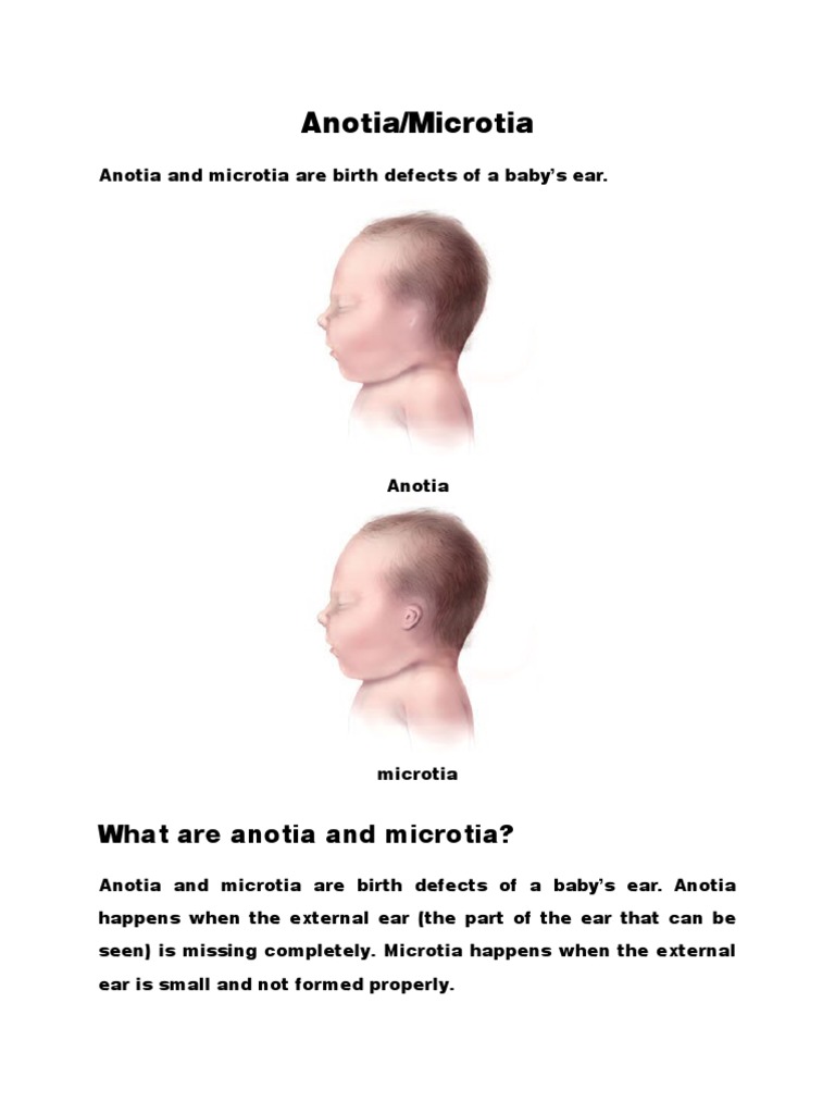 What Are Anotia and Microtia? | PDF | Pregnancy | Pediatrics