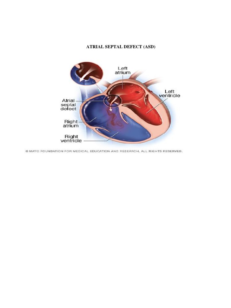Atrial Septal Defect Asd Pdf
