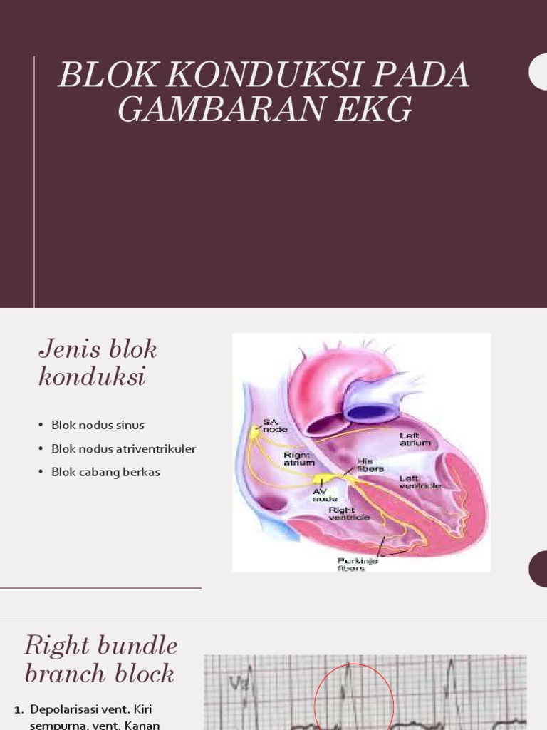 Ekg LBBB Dan RBBB | PDF