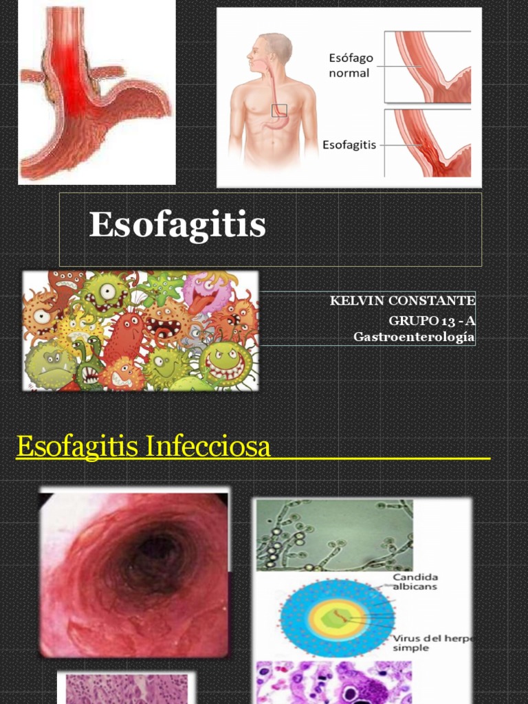 Esofagitis Infecciosa: Diagnóstico y Tratamiento | PDF ...