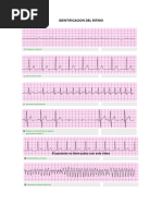 Pre-Evaluacion SVCA ACLS AHA 2015 Con Los Trazados Del EKG y Respuestas | PDF