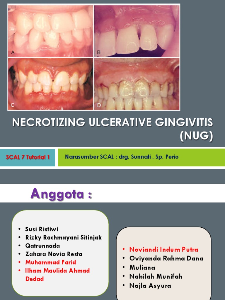 NUG: Necrotizing Ulcerative Gingivitis | PDF