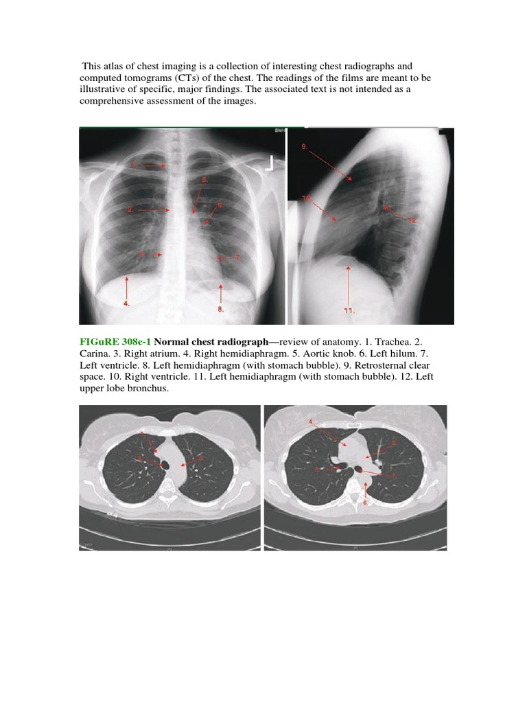 Figure 308E-1: Normal Chest Radiograph-Review of Anatomy. 1. Trachea. 2 ...
