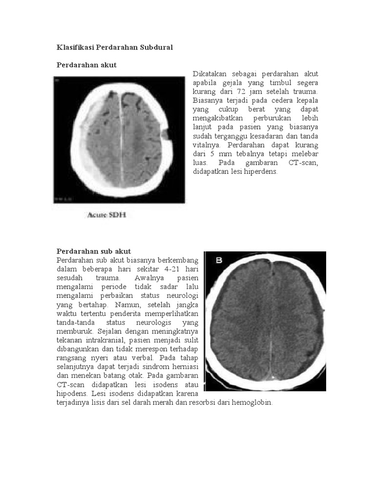 Klasifikasi Perdarahan Subdural | PDF