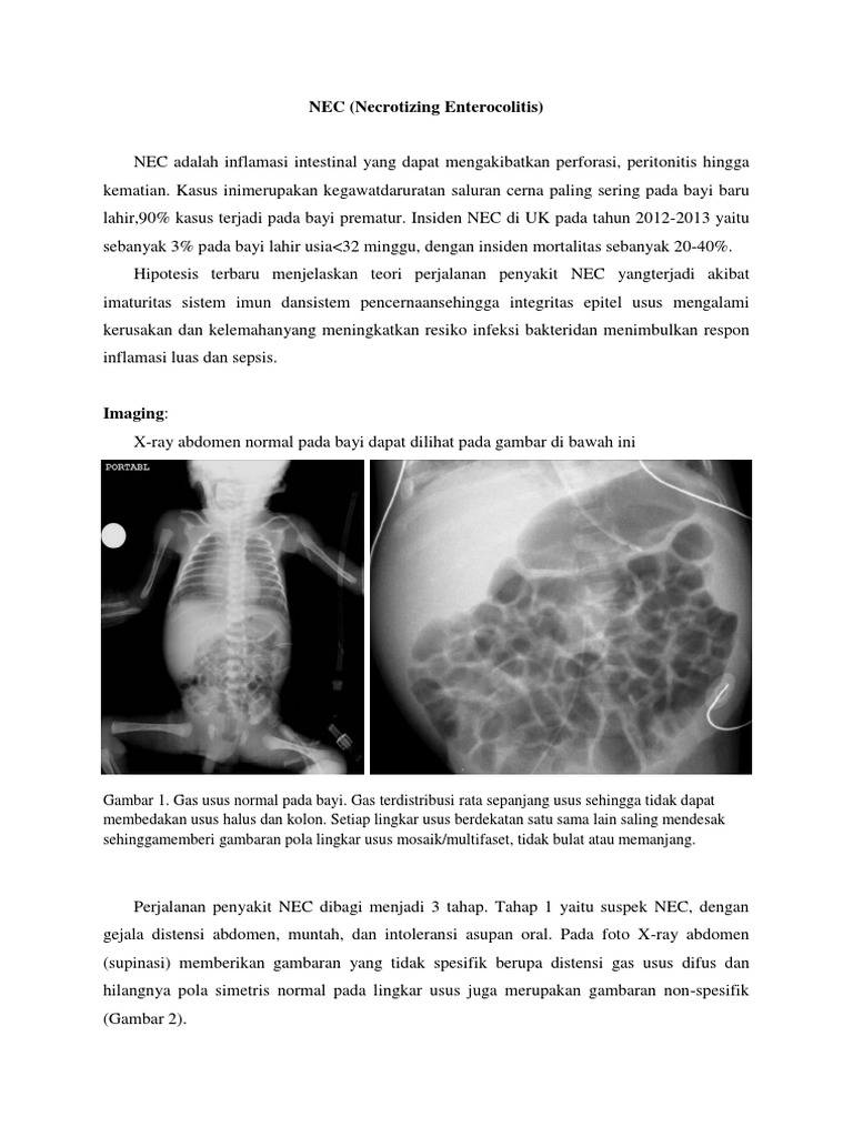 NEC (Necrotizing Enterocolitis) Radiology | PDF