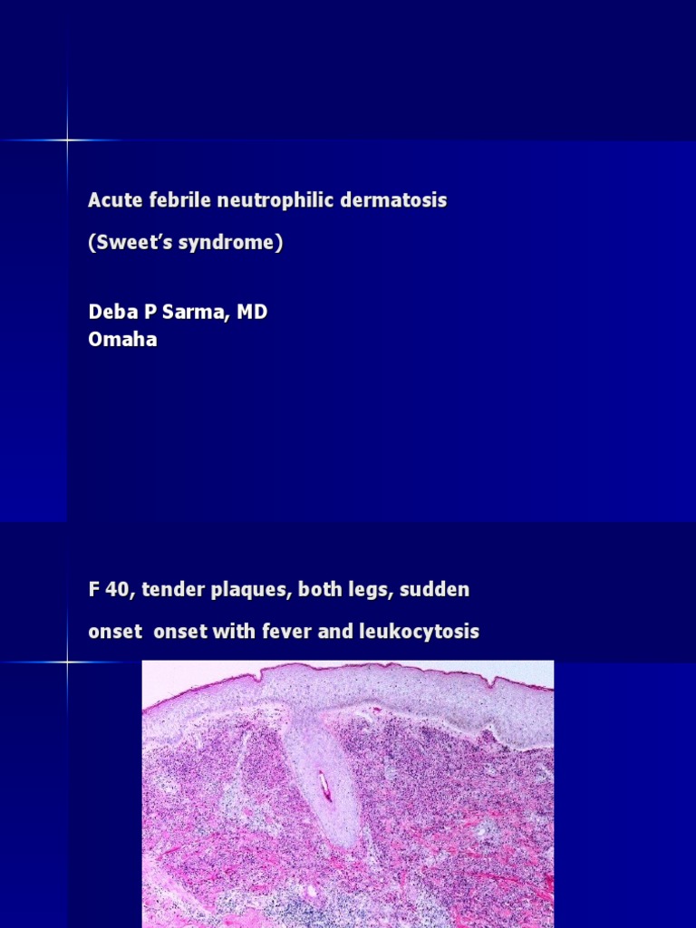 Sweet's Syndrome Overview and Associations | PDF | Politics