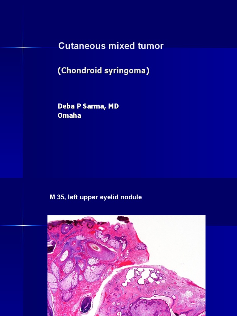 Cutaneous Mixed Tumor (Chondroid Syringoma) - M 35, Left Upper Eyelid | PDF