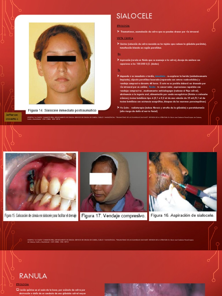 SIALOCELE | PDF | Saliva | Lesión